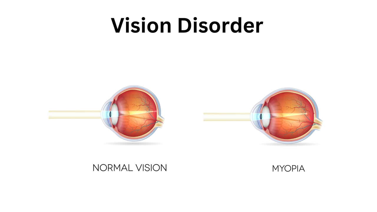 What is Nearsightedness (Myopia)?